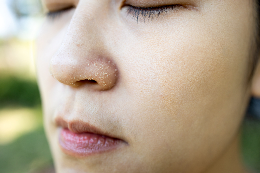 Dry Skin Around Nose Everything You Must Know Animascorp Dry Skin Around Nose Everything You Must Know Animascorp